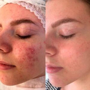 PRX-T33 | Aesthetic Medicine & Semi Permanent Makeup Preston